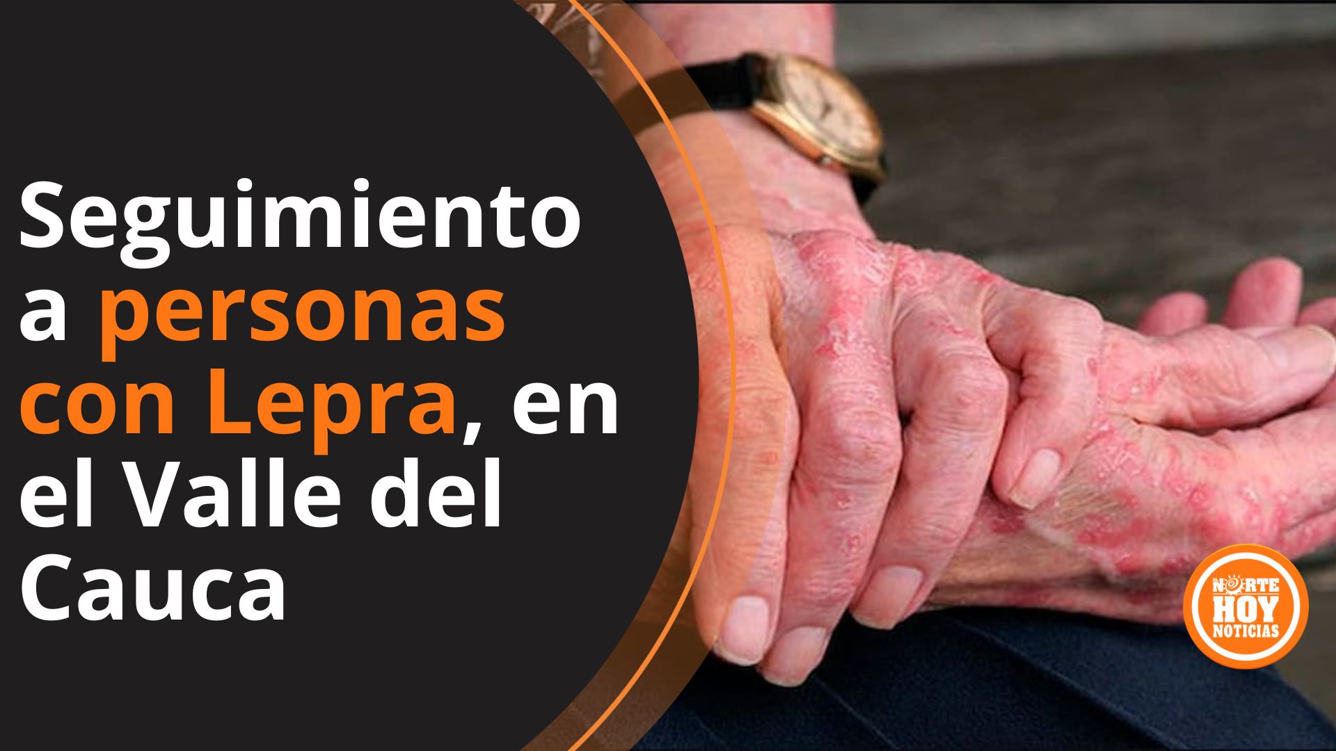 Gobierno departamental les hace seguimiento a casos de enfermedad de Hansen o de lepra en el ...